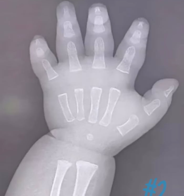 X-ray of an infant's hand reveals super tiny bones - 9GAG
