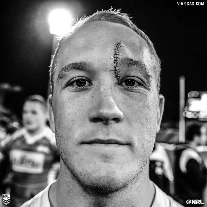 Rugby League player Jason Clark after suffering a head clash, getting ...