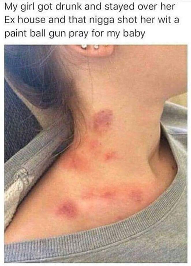Serious bruises.. What is wrong with that dude? - 9GAG