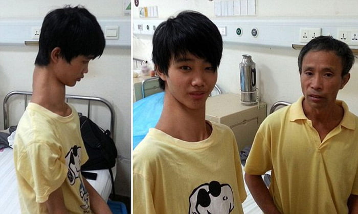 Chinese teenager with unusually long neck. He has three extra verbetrae ...
