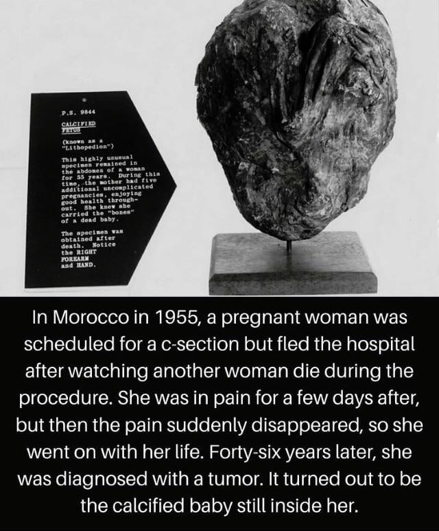 Calcified Baby - 9GAG