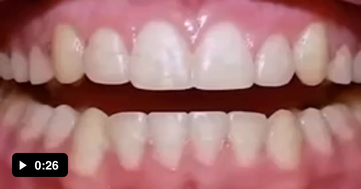 How the British get their amazing teeth - 9GAG