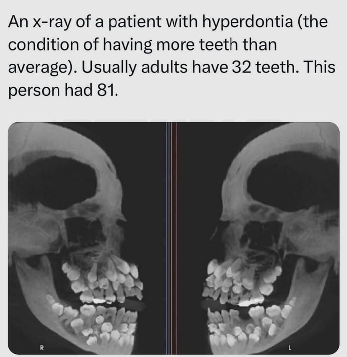 An incredible X-ray showing hyperdontia, a condition where a person has significantly more teeth ...