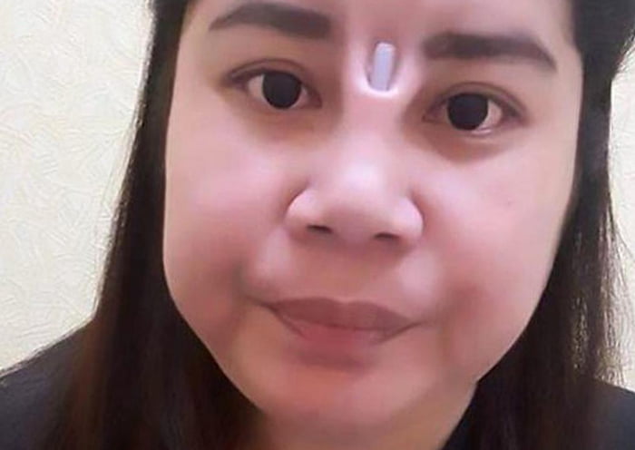 Silicon implant protruding out of nose after botched nose job - 9GAG