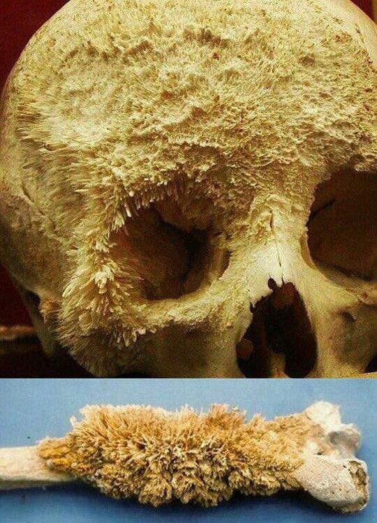 This Is What Bone Cancer Looks Like - 9GAG