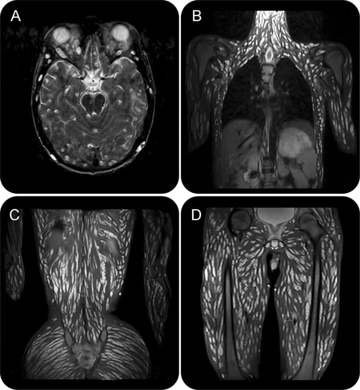 The human body diagnosed with disseminated cysticercosis - 9GAG