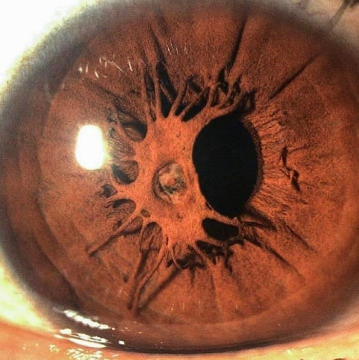 An iris growing over a pupil. - 9GAG