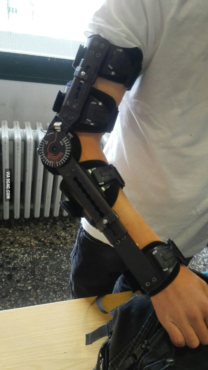 My friend broke his arm and after a surgery he gets this thing...He is ...