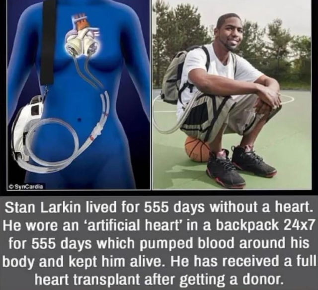 Man Lived Without A 'Real' Heart For 555 Days, Carried An Artificial ...