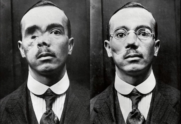 Example of early face surgery for ww1 wounded soldier. - 9GAG