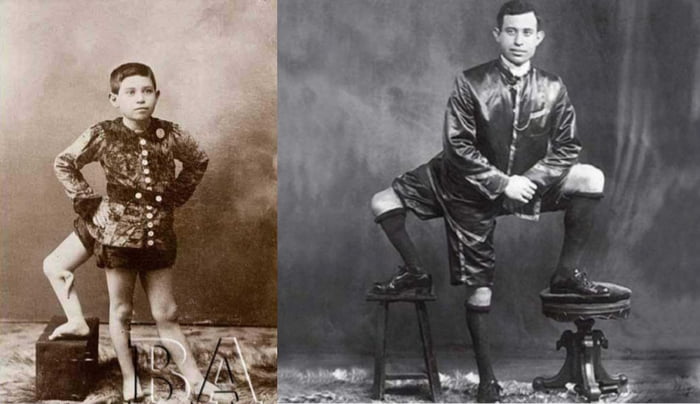 Frank Letini (1889-1966) had 3 legs, 16 toes and 2 "private organs" due ...