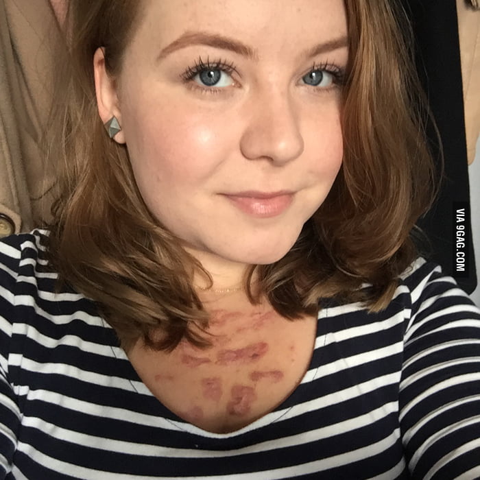 Everyone showing their scars. These are mine (keloid scars). - 9GAG