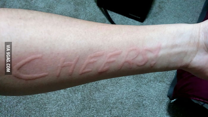 Write Anything On My Skin Aka Dermatographia
