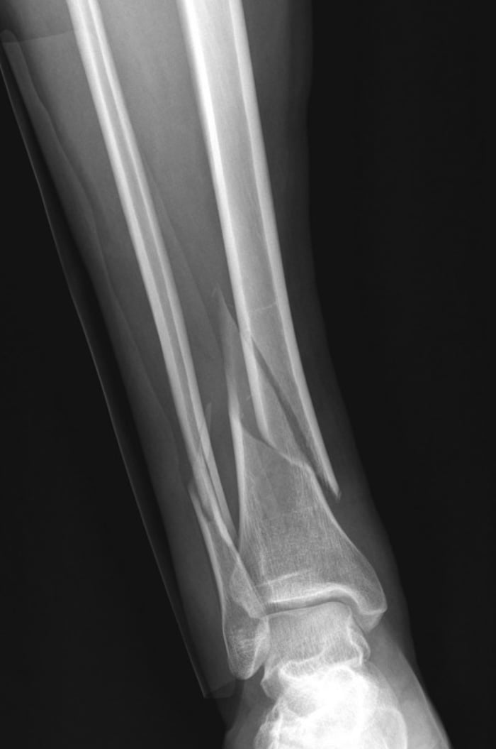 Conor McGregor (Tibia and Fibula) Leg Fracture - 9GAG