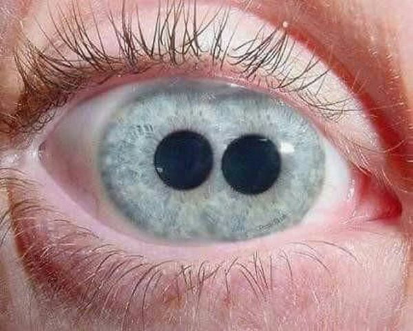 Two working pupils in the same eye, they each have their own sphincter ...