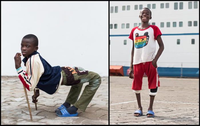 A young boy named Ulrich before and after surgery to fix his backwards ...