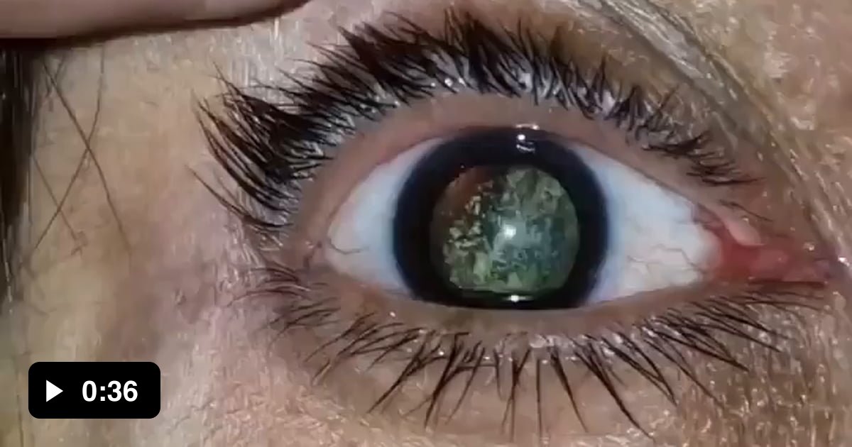 Hialosis asteroidea is a condition that makes your eyes look like a ...