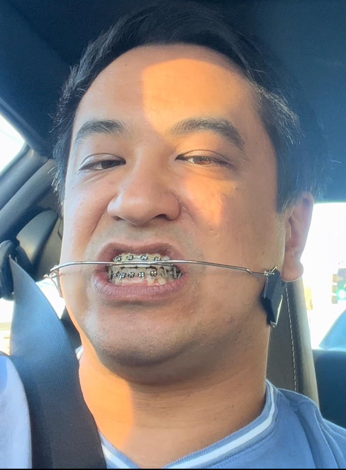 Getting headgear as an adult - 9GAG