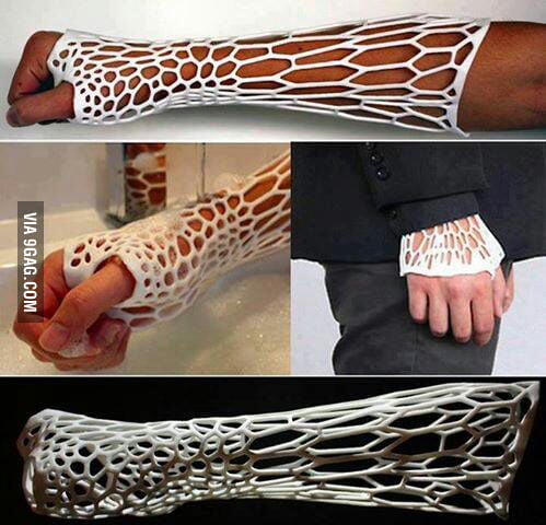 3D printed exoskeleton for broken arms - 9GAG