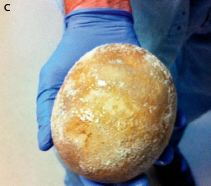 A kidney stone the size of a small ostrich egg just removed from a man ...