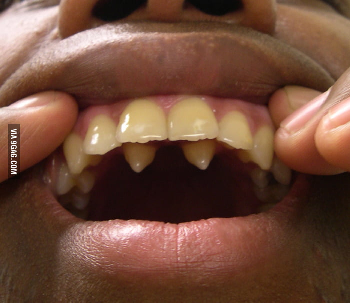Extra teeth - 9GAG