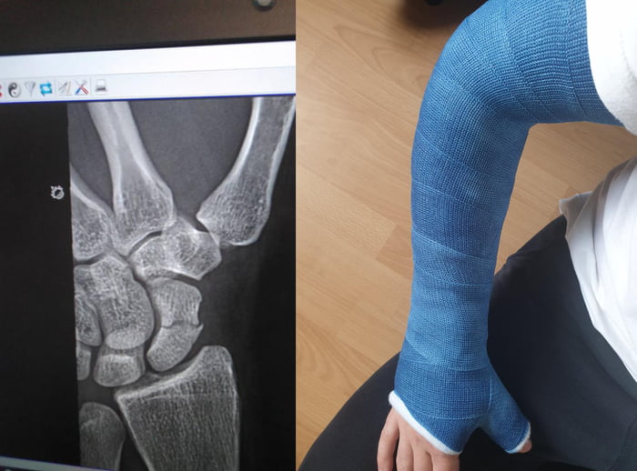 Apparently breaking this teeny tiny wrist bone = massive f**king full ...