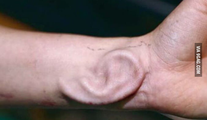 Belgian doctor grew an ear on a cancer patient's forearm so she could ...