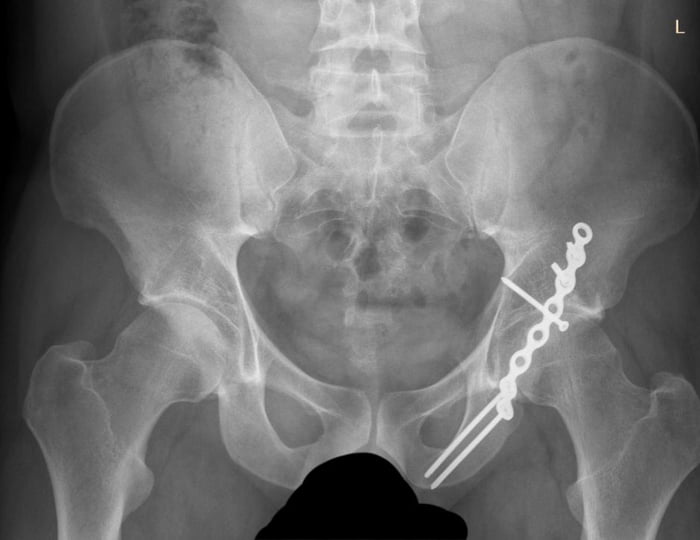 Dislocated my hip so badly I shattered the socket. Now it hurts 24/7 ...