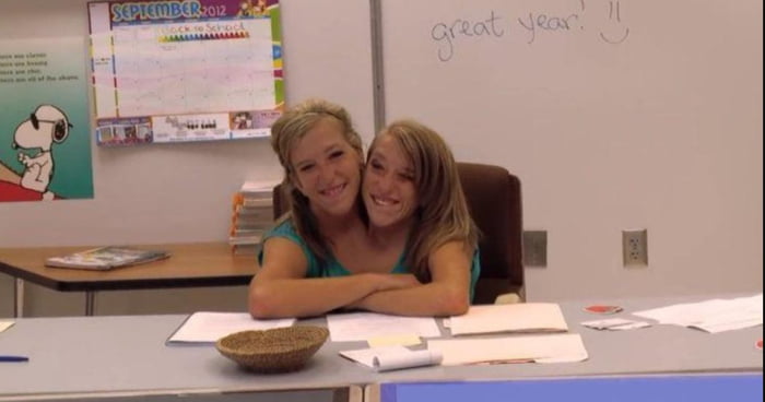 Conjoined twins born with a 1/30 million chance of survival are now ...