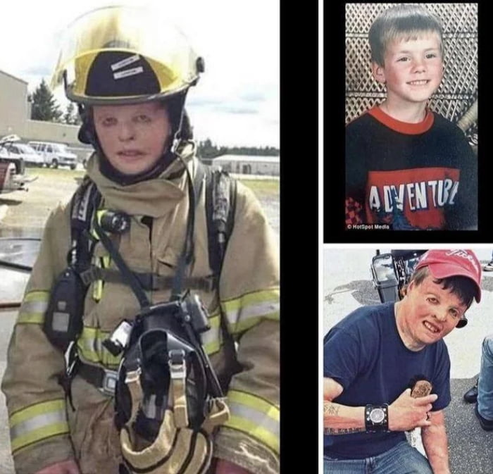Despite suffering severe burns as a child, this man went on to become a firefighter - 9GAG