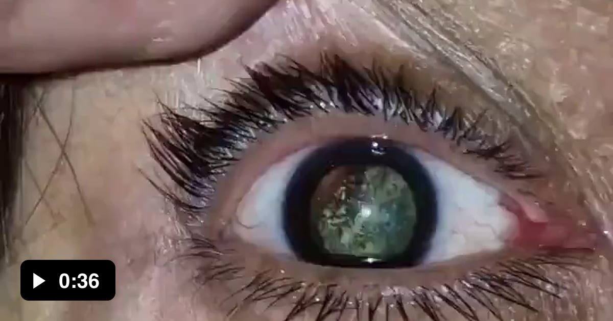 Asteroid hyalosis is a fascinating and relatively rare eye condition ...