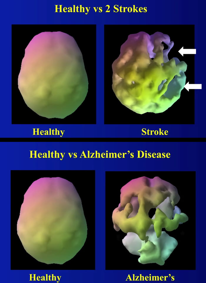 Medical scans of brain activity: Healthy Brain vs Stroke Brain vs ...