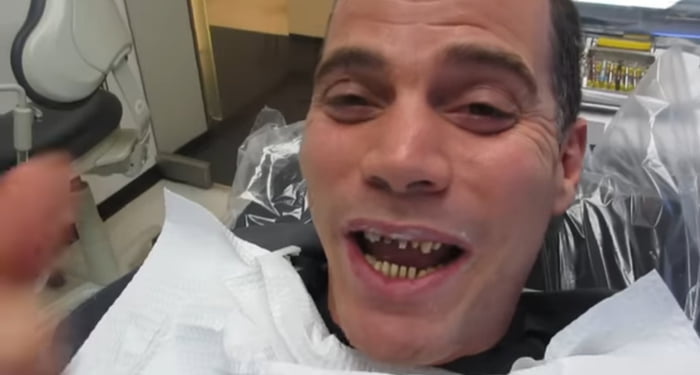 Steve o s real teeth - 9GAG