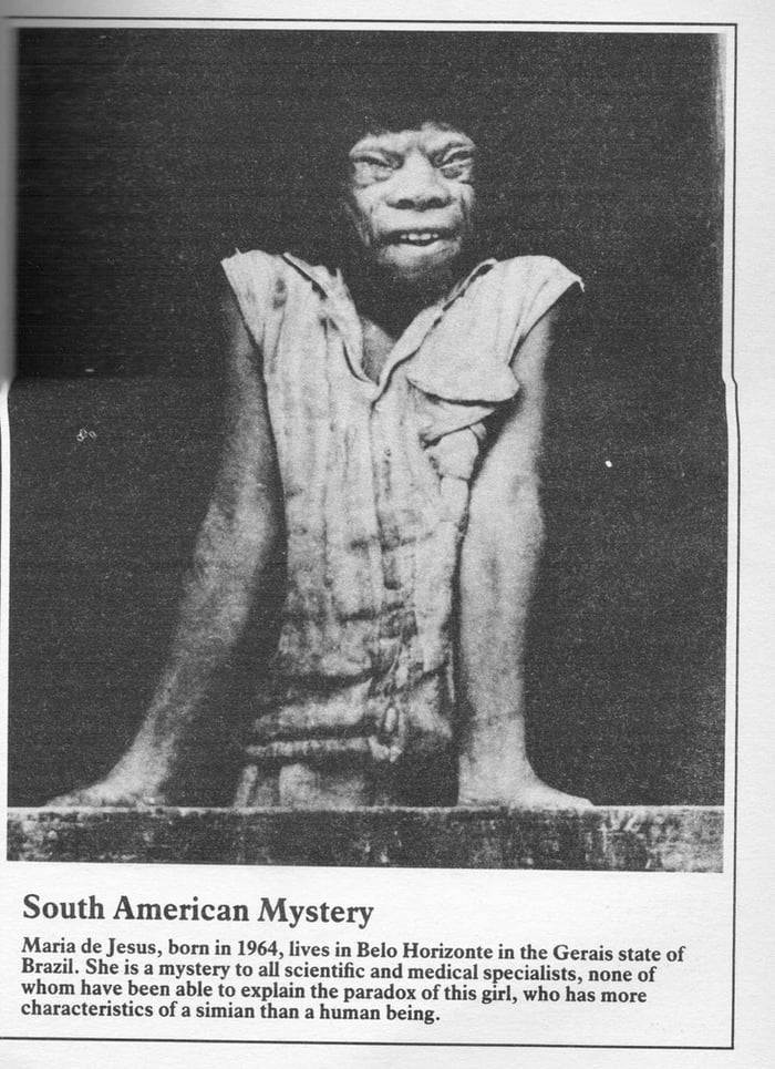 Mary de Jesus, the “Beast Woman” of Brazil, born in 1964, "has more ...
