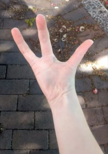 My gf had seasonal eczema on her hands. So the doctor asced her to take ...
