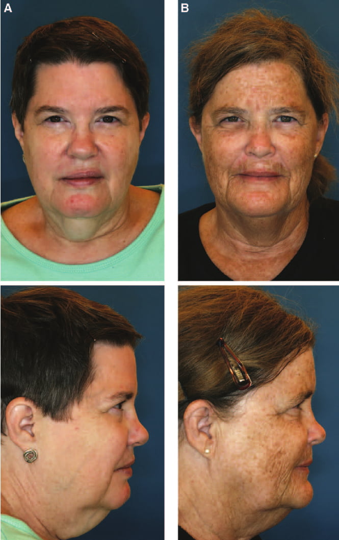 The difference in aging between twins - one smoked and sunbathed, the ...