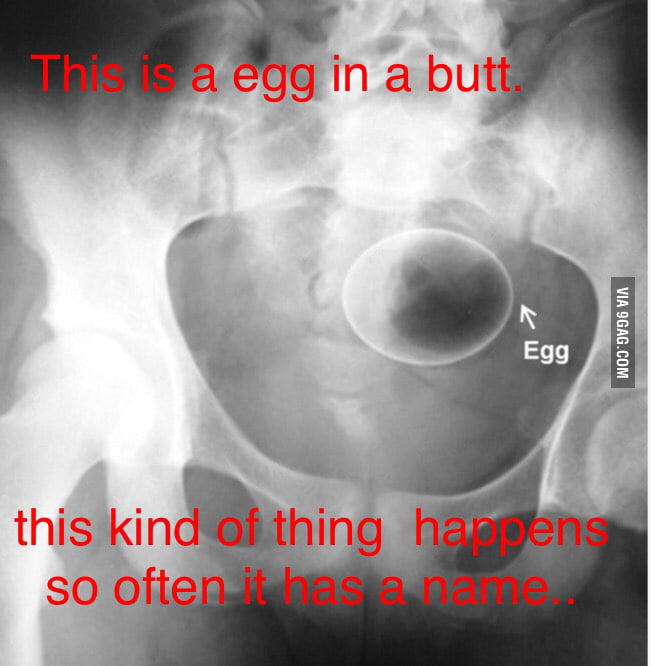 Rectal foreign body - Google it. A nice collection of x-rays. - 9GAG