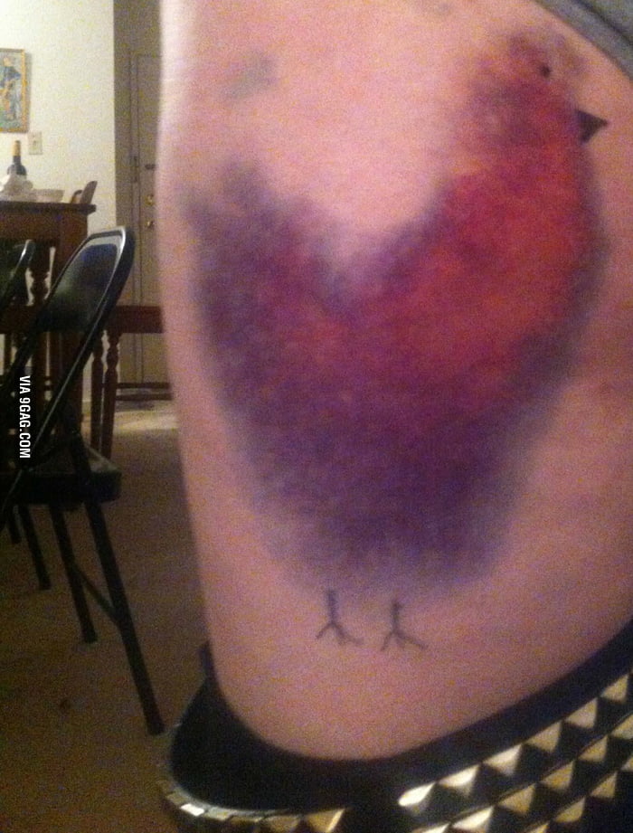 My friend fell hard and got this chicken bruise - 9GAG
