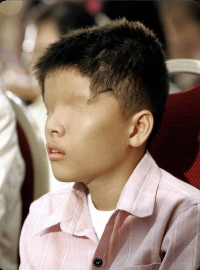 A 14 year old Vietnamese boy who was born without eyes because of the ...