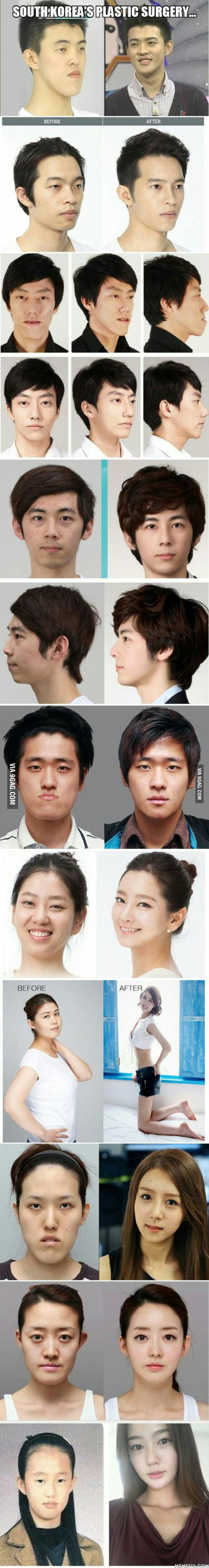 Plastic surgery in South korea before and after - 9GAG