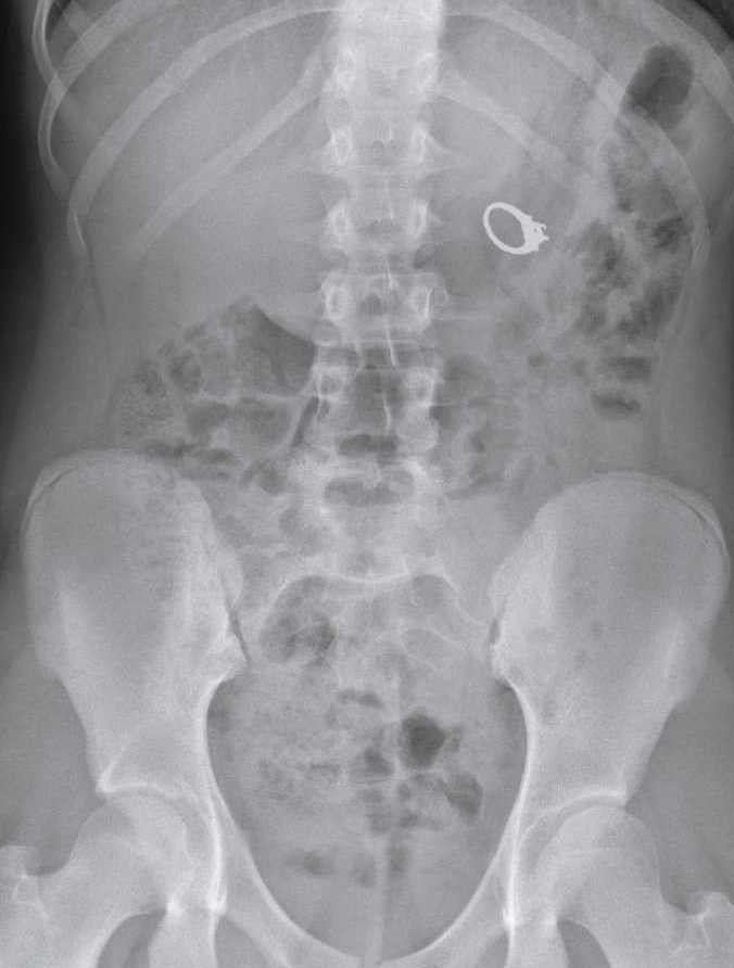 He attempted to surprise propose in a restaurant. She got an x-ray ...