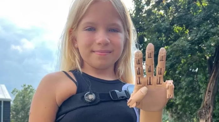 9 year old Sasha Filipchuk who lost her arms because of Russians, is ...