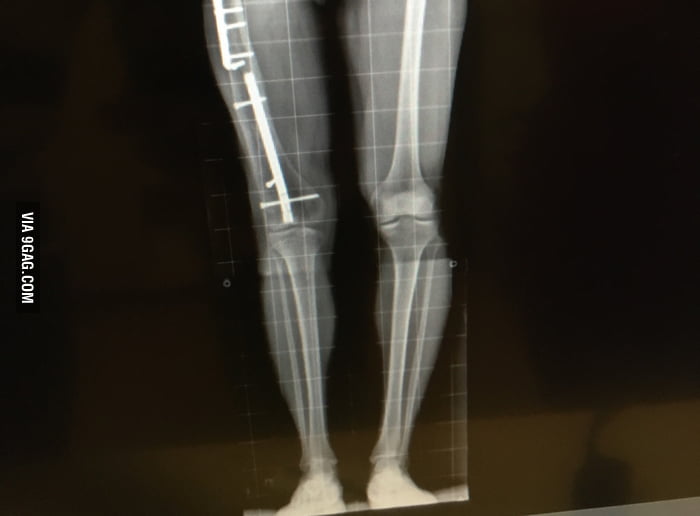 I had pffd (proximal femoral focal defitioncy) had over 41 surgeries ...