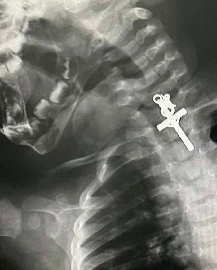 This is a real x-ray result. Now I wonder what led to this. - 9GAG