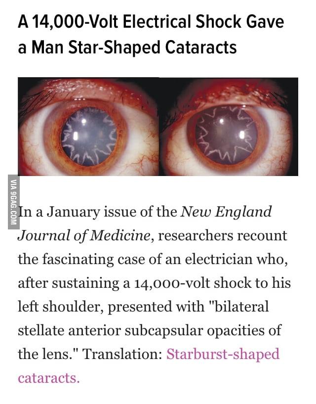Scary! Star-Shaped Cataracts! - 9GAG