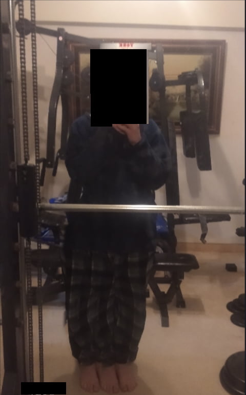 A Boy born with 3 legs - 9GAG