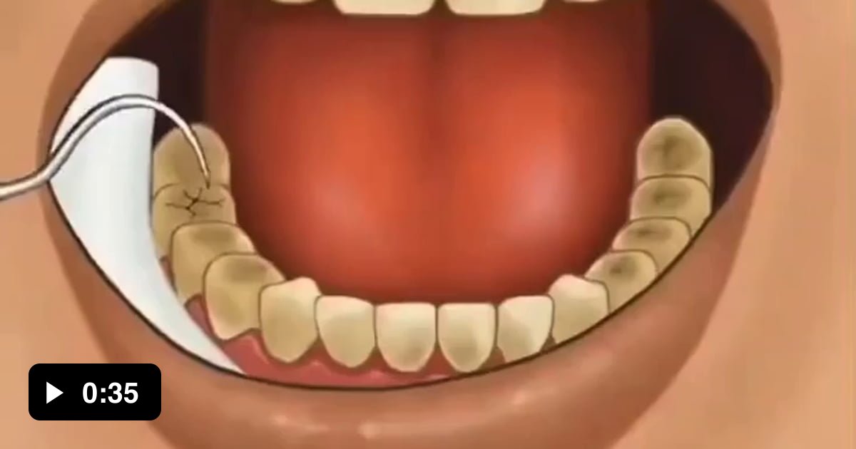 How fixing tooth works - 9GAG