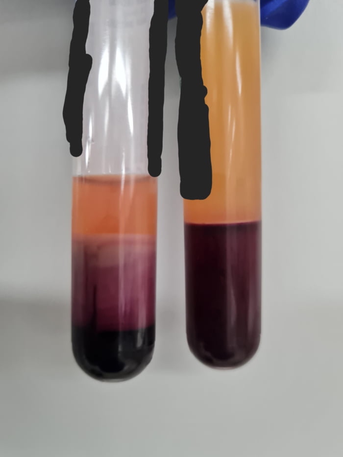 Where Leukemia (leukos=white, emia=presence in blood) got its name from ...