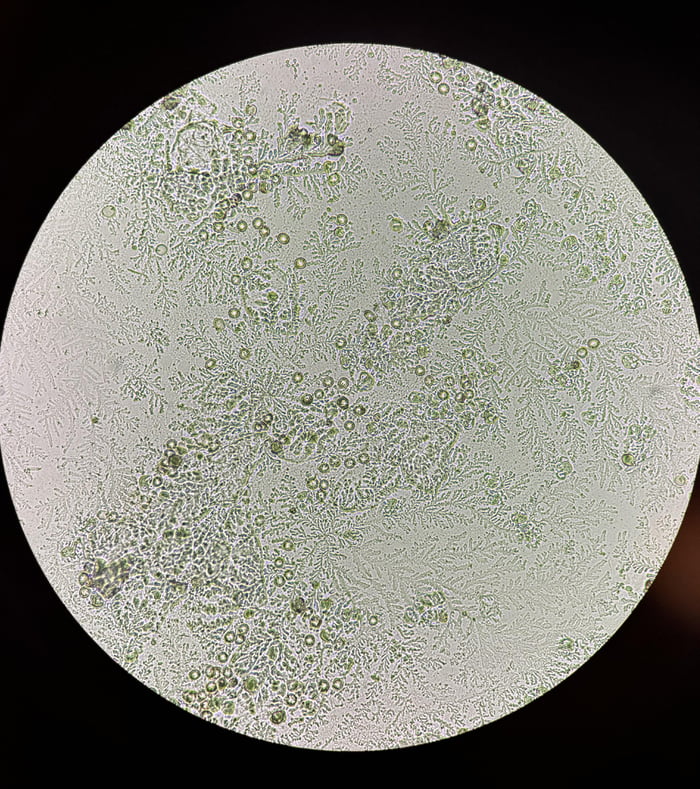 What dried amniotic fluid looks like under a microscope (known as ...